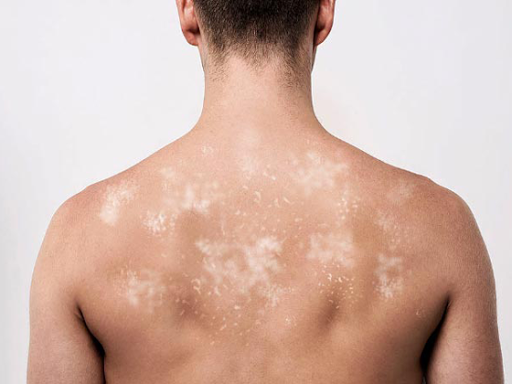 Hanseníase: Brasil tem quase 30 mil casos por ano - Rádio Santana FM ...